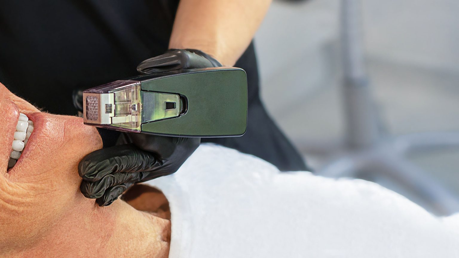 Morpheus 8 Treatment for Acne Scars | Advanced Skin Repair at Amara